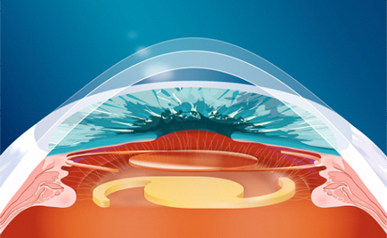 Add on （アドオン）IOL（眼内レンズ）｜自由診療（保険外治療）- 森井眼科医院